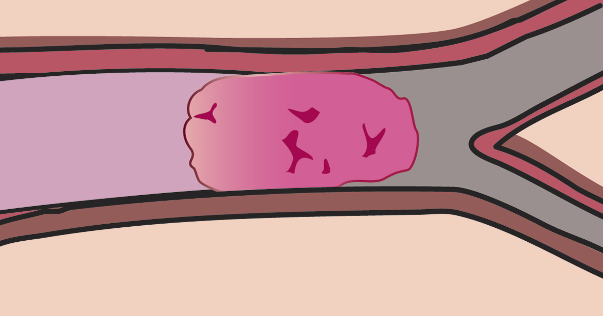 A blood clot in the brain - Ischemic stroke